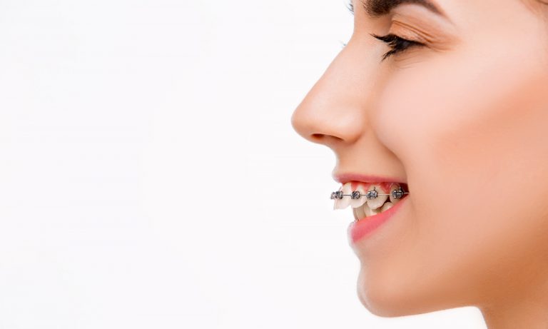 Gigi Tonggos, Pengaruhnya pada Estetika dan Kesehatan - Wibowo Dental ...